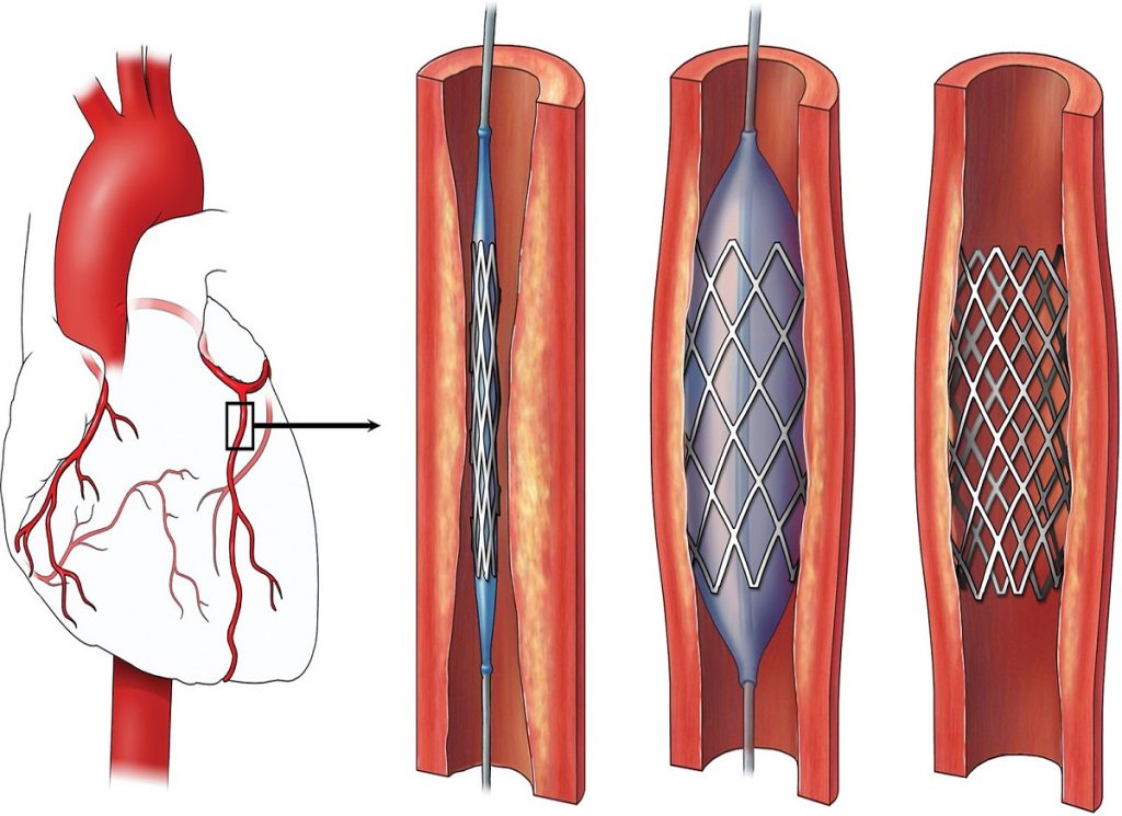 Angioplasty – Shripad Heart Centre