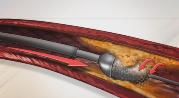 Rotablation – Shripad Heart Centre