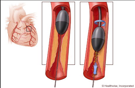 Rotablation – Shripad Heart Centre